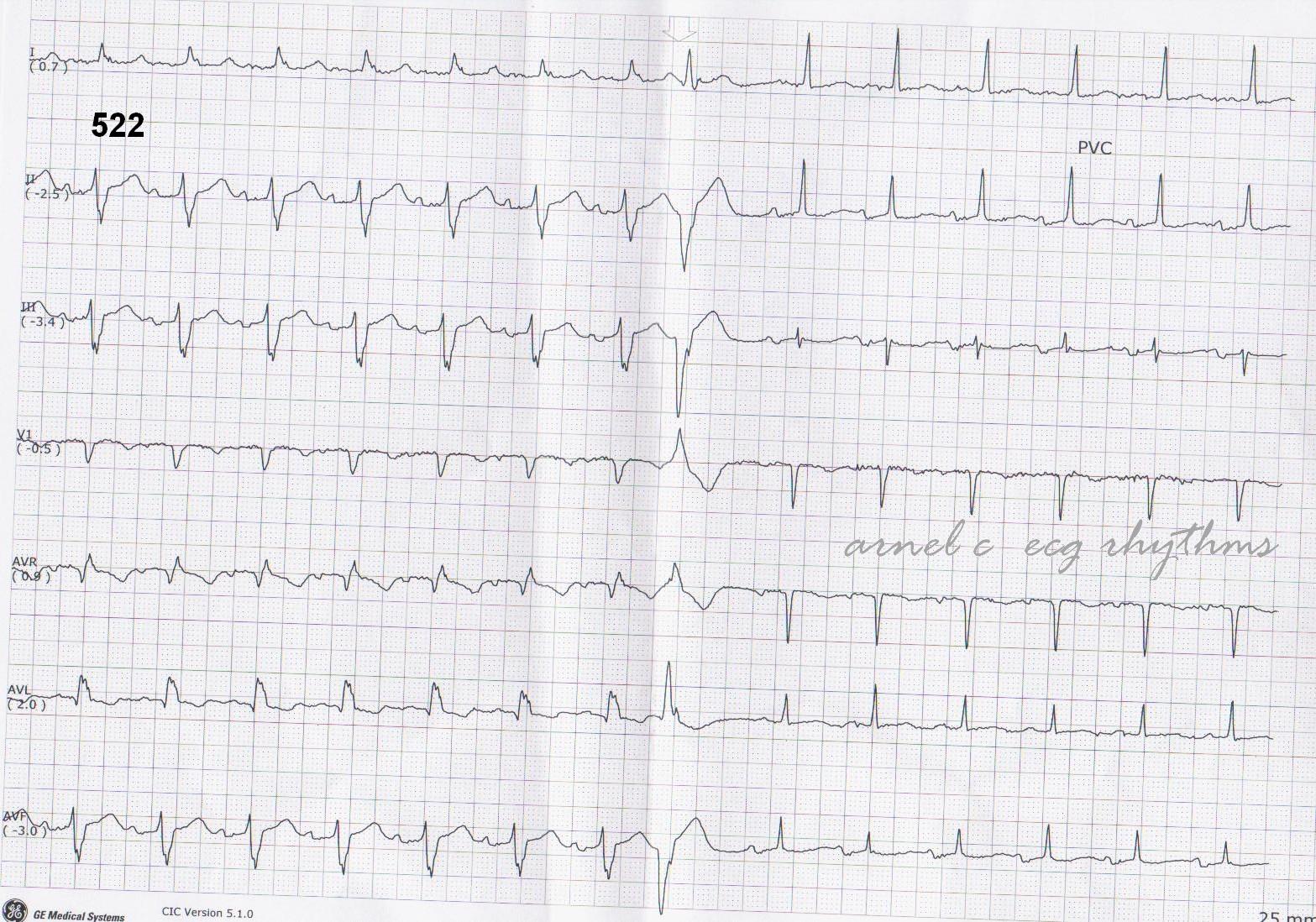 ECG Rhythms: So, the body can restore BBB to normal