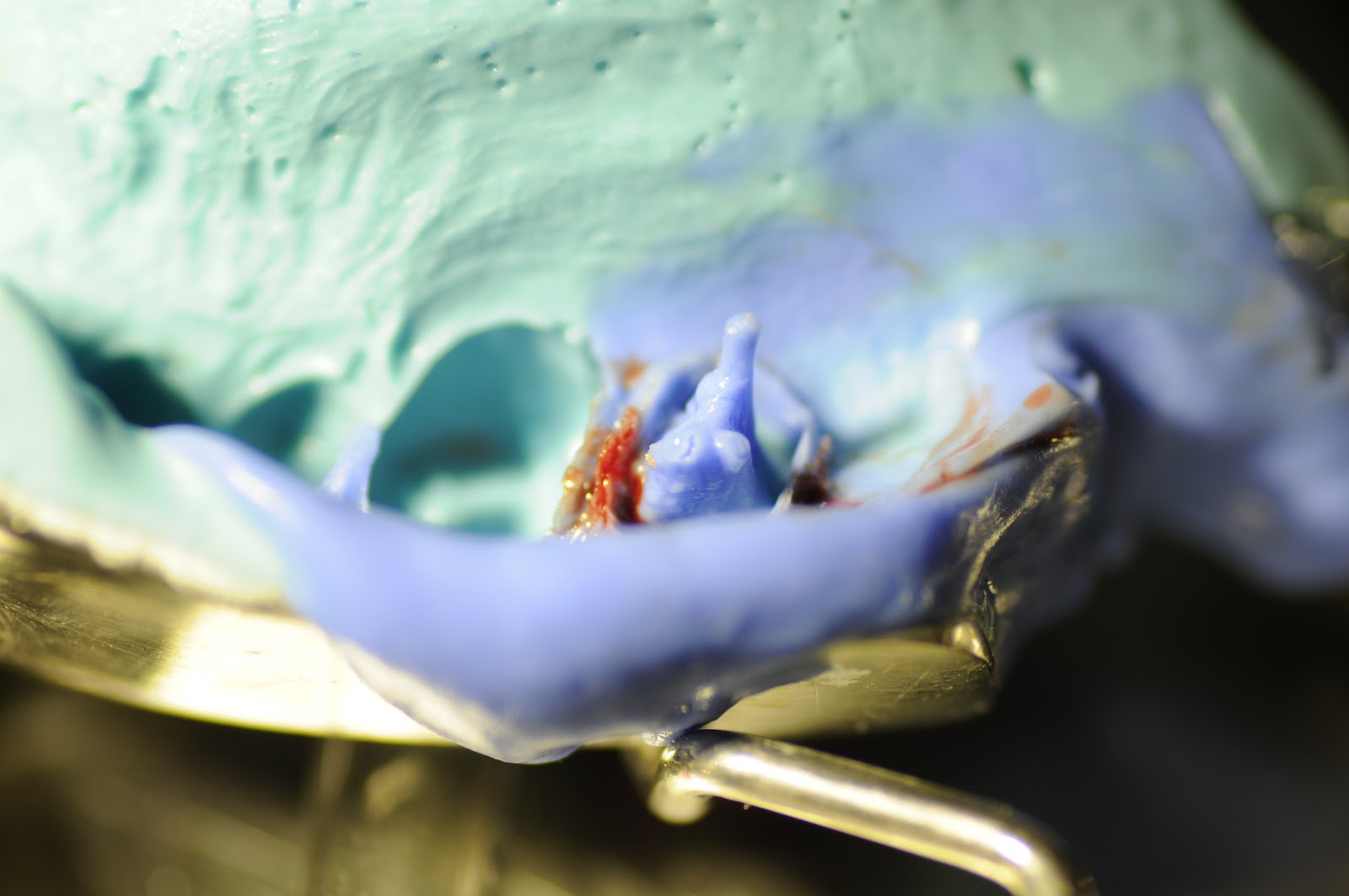 Empreintes TFM: Tenon faux moignon IC: Inlay core ACR: Ancrage corono ...