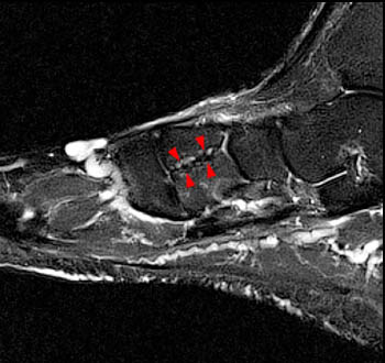 MRI Musculo-Skeletal Section: Bipartite medial cuneiform.