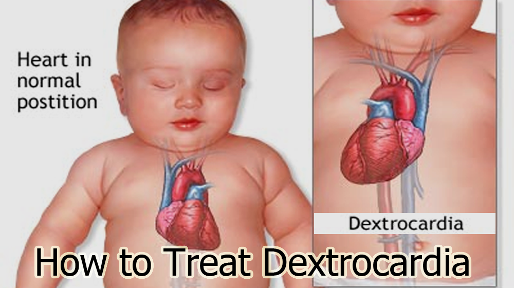 How to Treat Dextrocardia