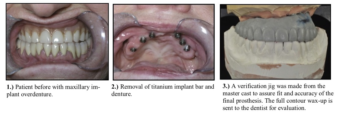 Niche Dental Marketing: Dental Laboratory Implants Solutions: Porcelain ...