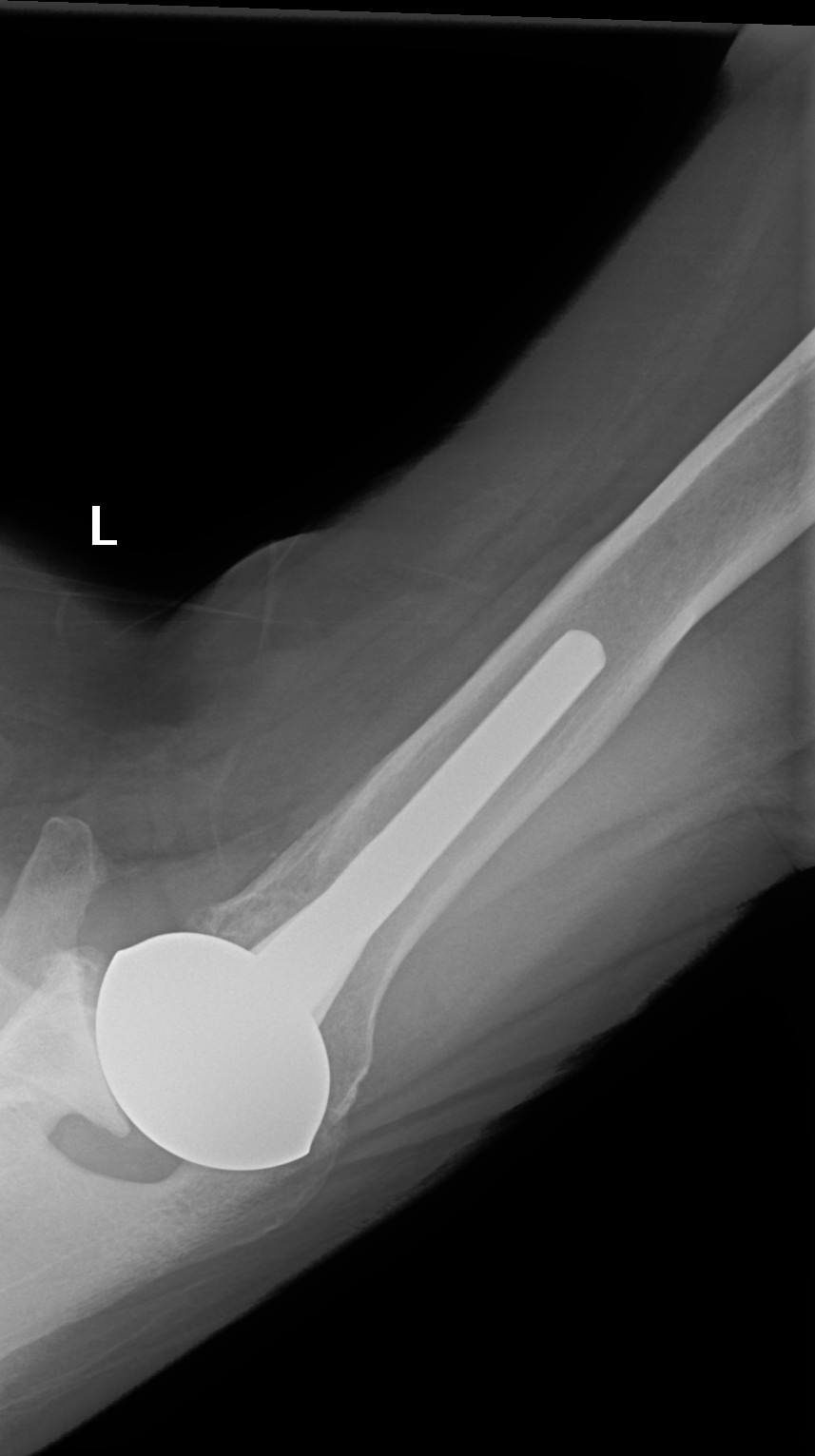 UW Shoulder and Elbow Academy: Rotator cuff tear arthropathy and the ...