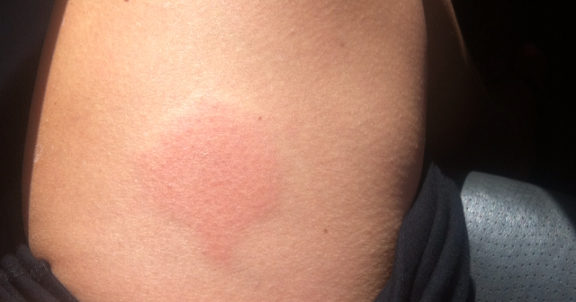 BROWNELL - Brown, like the color, e-l-l: Enbrel Injection Site Reactions