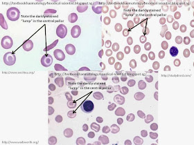 Haematology in a NutShell: Target Cells (Codocytes)