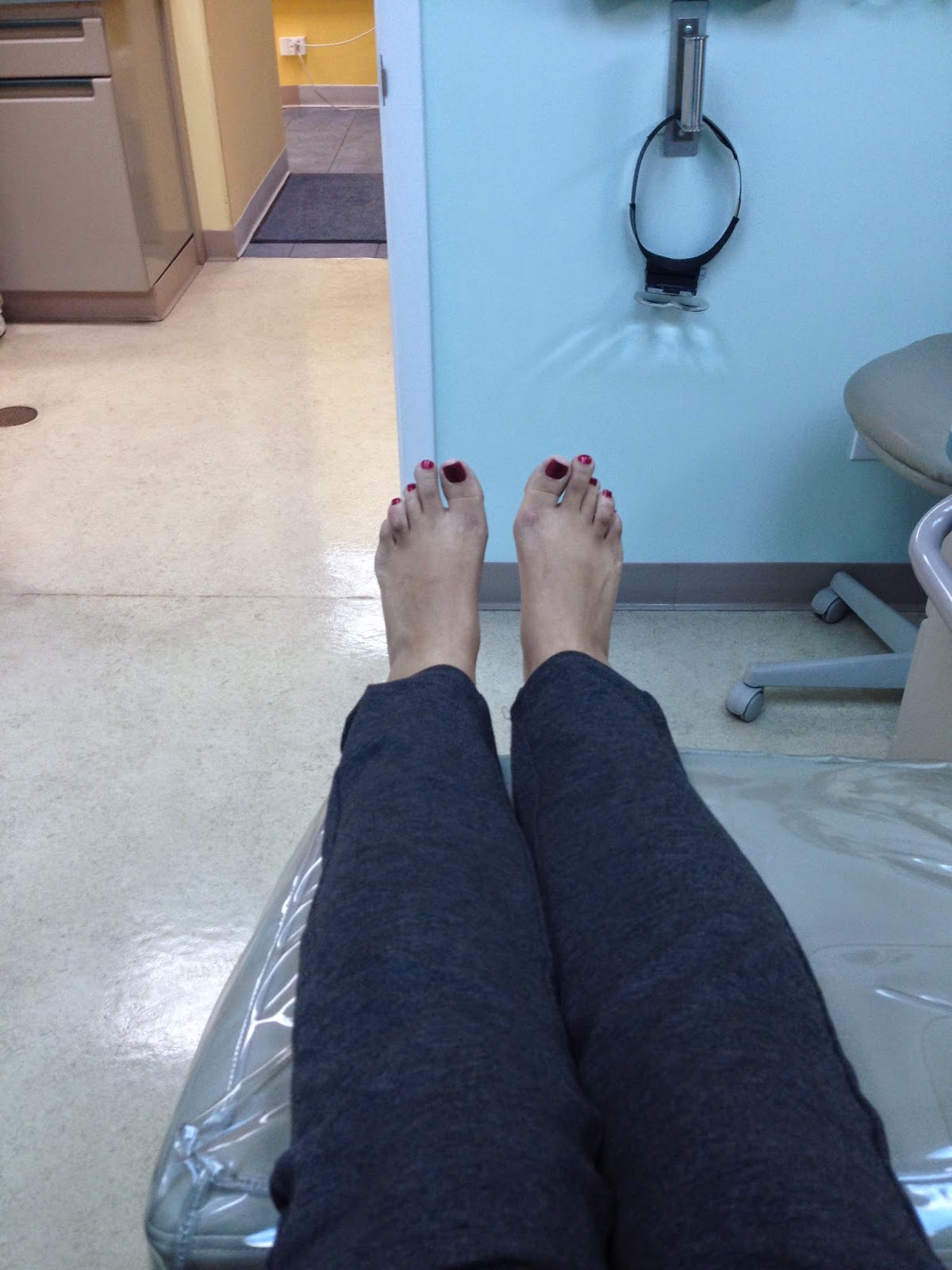 My Toe Shortening Surgery Experience : First Toe, Left Foot!