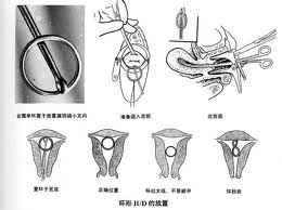 Puskesmas Gunung Megang: IUD (intra uterine device, spiral)