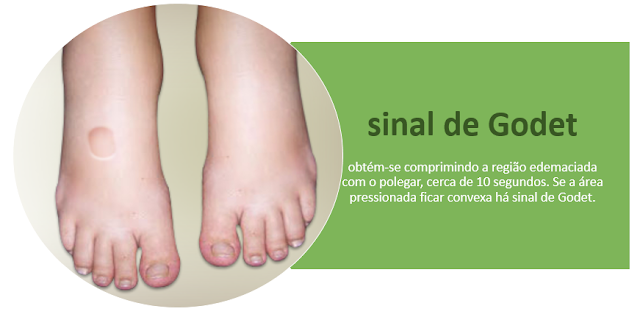 L de linfa: Lipedema,vs linfedema - efeitos no sistema linfático