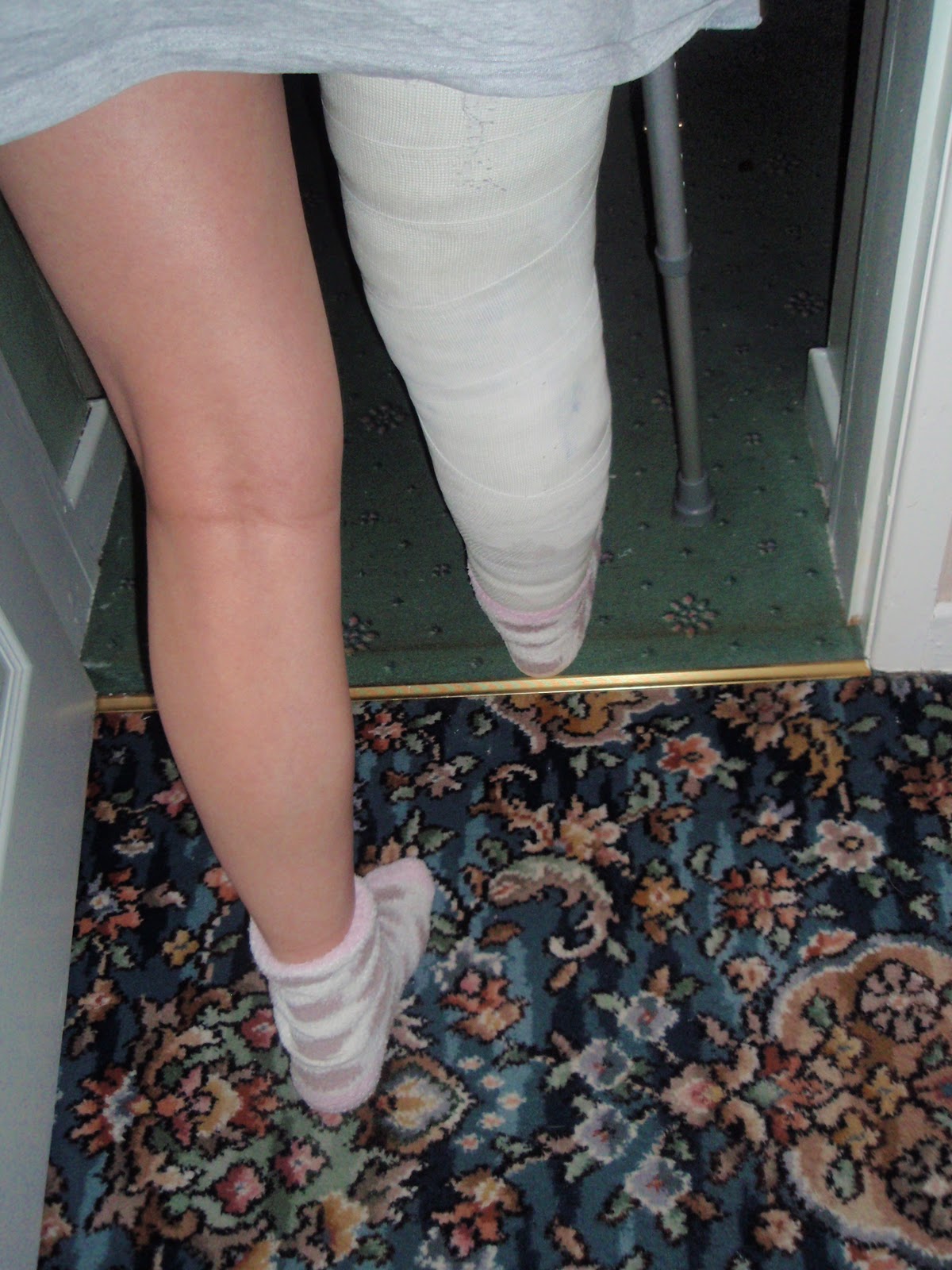 My Broken Knee Story