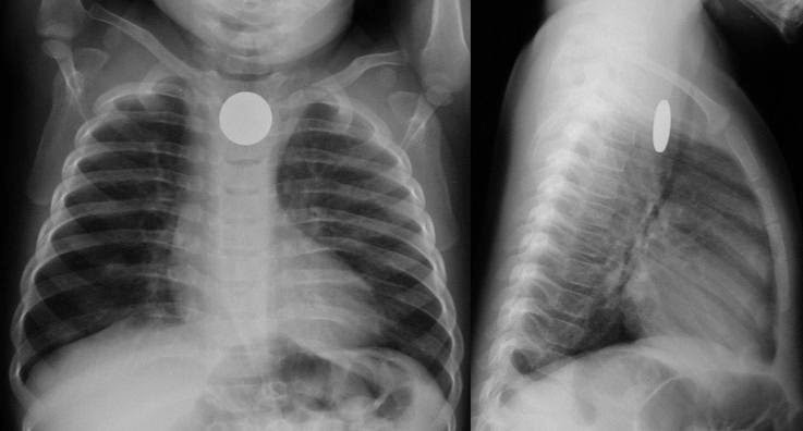 Random Rambles: Button battery vs coin ingestion