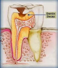 Omni Dental Group: Dentin Decay