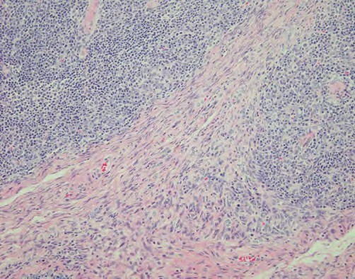 [Pathology] Atlas of Lymphocyte-Rich Spindle-Cell Thymoma (WHO Type AB ...