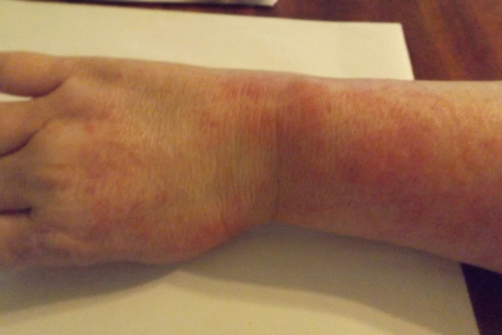 Scrambled Eggs , Surviving Ovarian Cancer