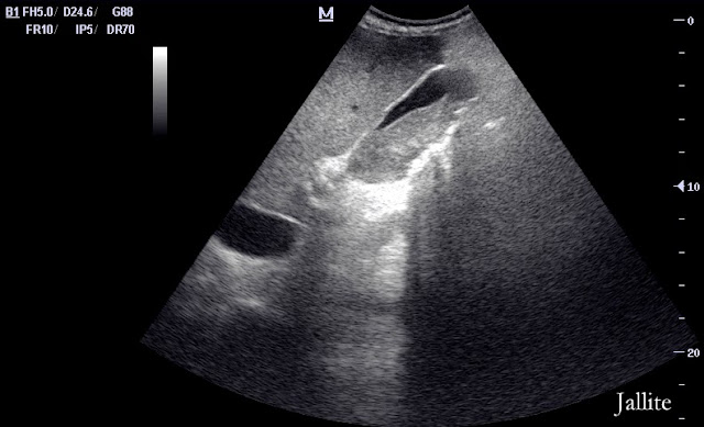 Calculo Conducto Cistico