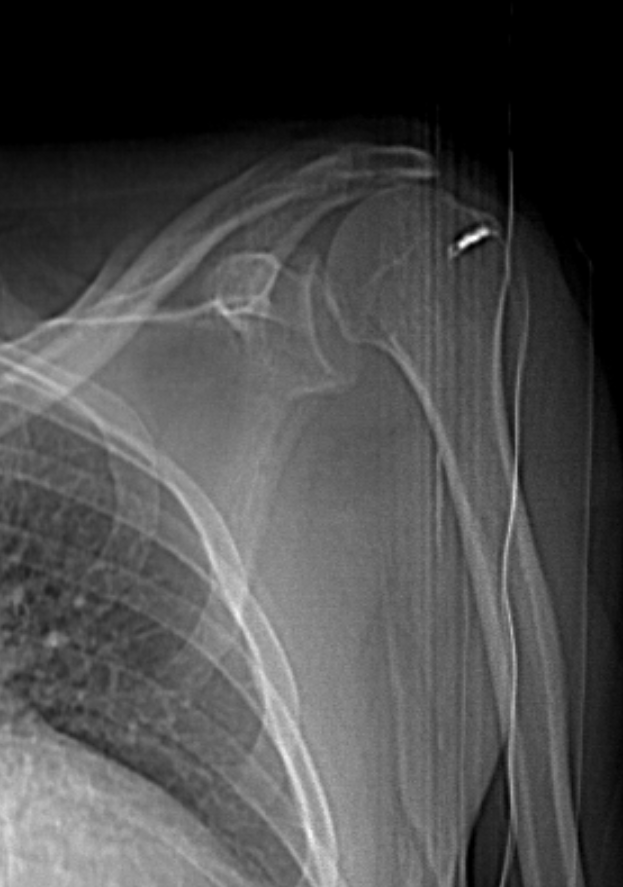 Shoulder and Elbow Surgery: Reverse shoulder replacement for ...