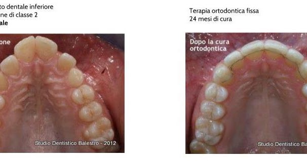 Studio Dentistico Balestro: Palato ogivale