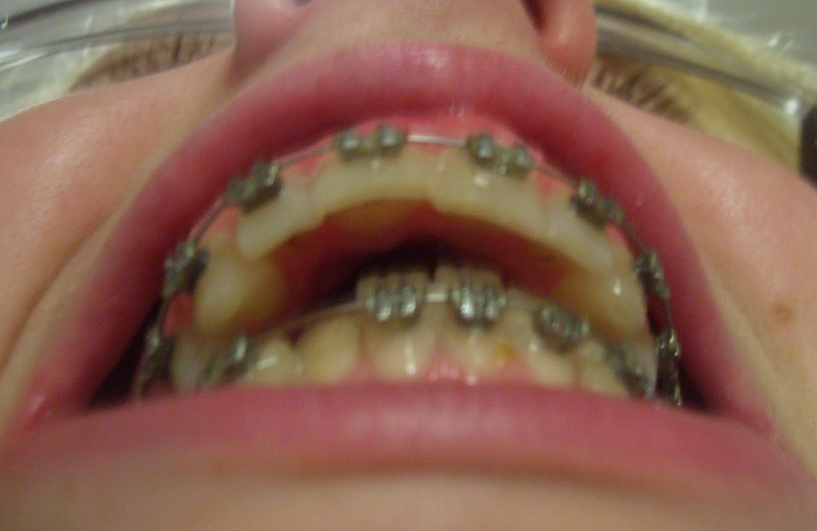 My Jaw Surgery Story: 1 month of braces