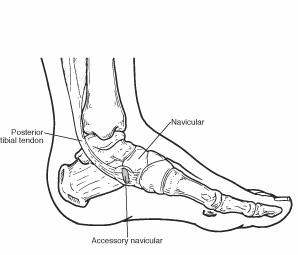 Running Solutions: Accessory Navicular Bone