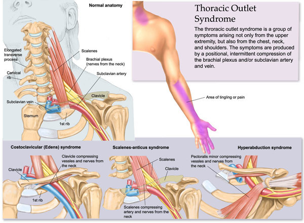 Physiotherapy For THORACIC OUTLET SYNDROME MANAGEMENT GUIDELINES Physiotherapy For THORACIC OUTLET SYNDROME MANAGEMENT GUIDELINES
