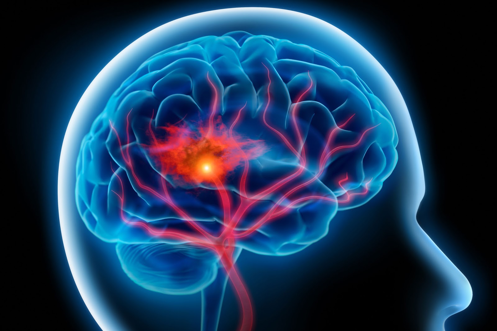 7 Early Warning Signs Of Stroke Everyone Should Know