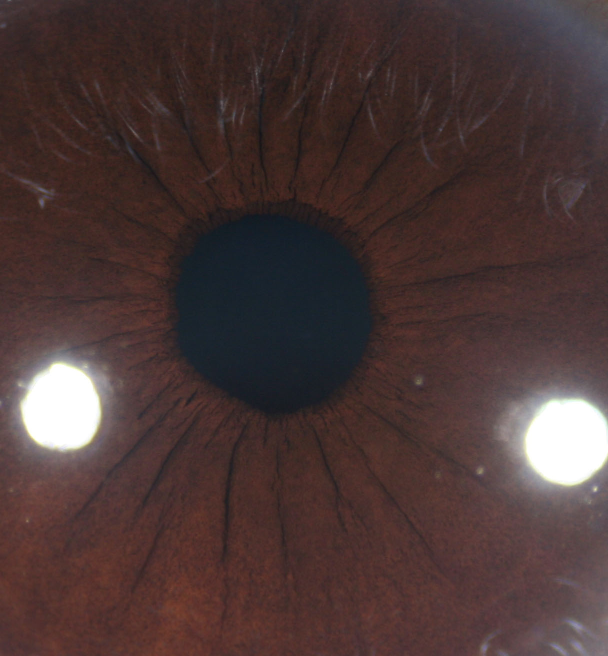 Modern & Multidimensional Iridology: Schwalbe's Contraction Furrows ...