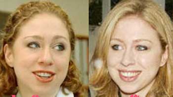 Chelsea Clinton Plastic Surgery Before and After Nose Job and Chin ...