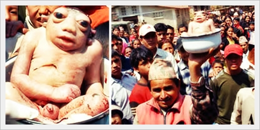 twenty2december™ : 10 Unusual Babies : Medical Conditions