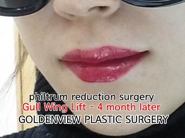 Goldenview Plastic surgery: Lip lift , Lip plastic surgery - phiptrum ...