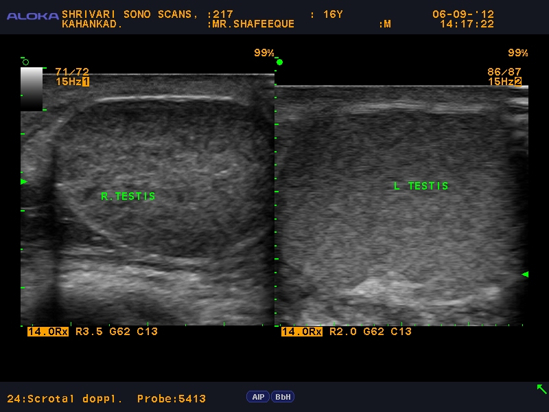 Shrivari Sono Scans: Ultrasound images in acute scrotum--Torsion Testis