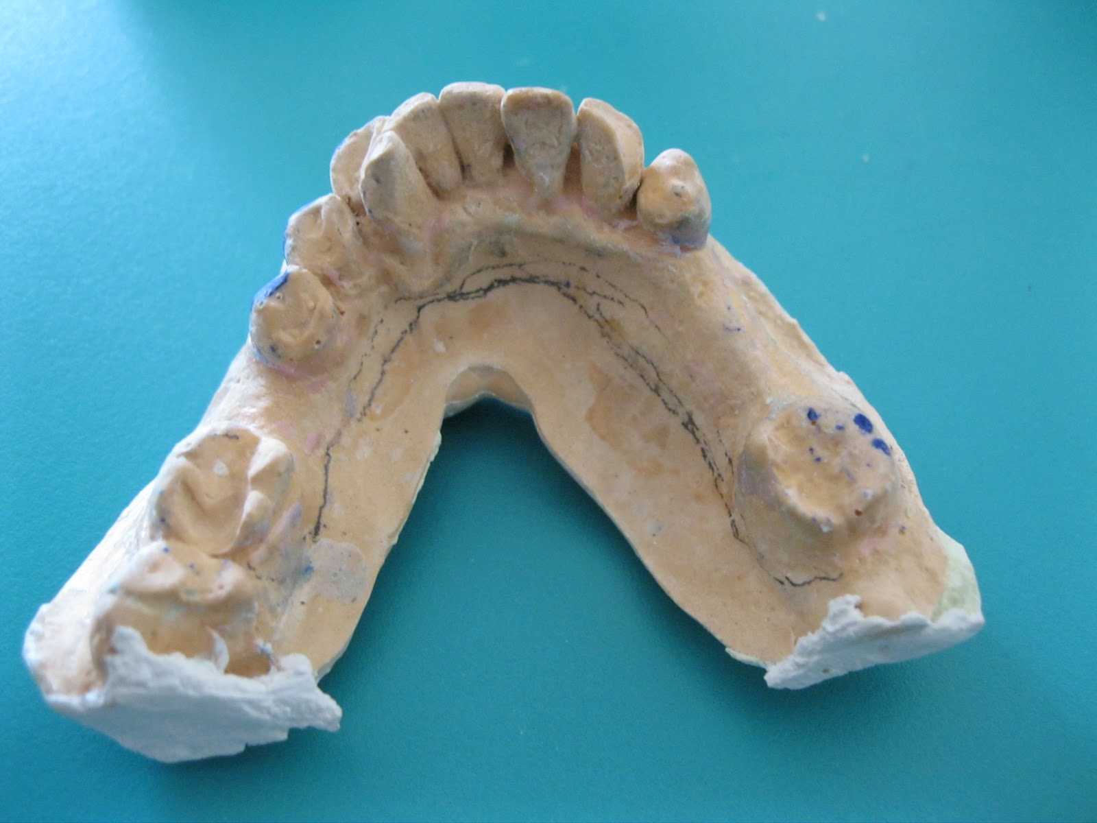 DENTO CARE DENTAL CLINICS: FLEXIBLE DENTURES-ROMOWABLE PARTIAL DENTURE