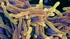 Mycobacterium Fortuitum Houstonense and a Foot: A Case of Surgical Site ...