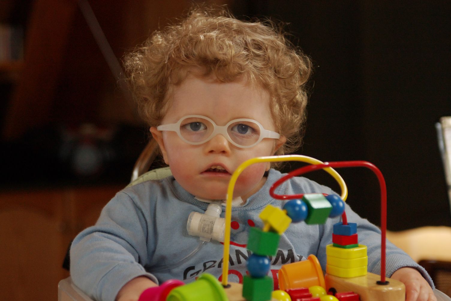 Moebius Syndrome - Pictures