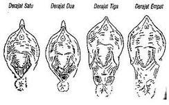 Tindakan Episiotomi | JURNAL BIDAN