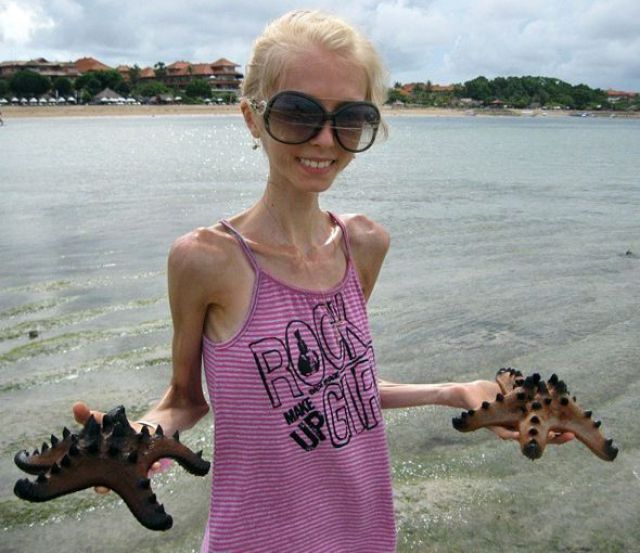 Ksenia Bubenko, a jovem mais magra do mundo com 20 kilos | Dicas para ...