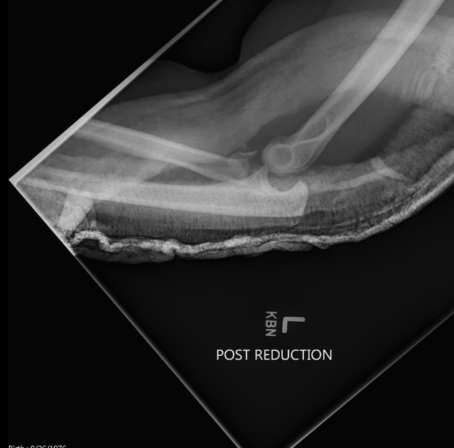 Shoulder and Elbow Surgery: Terrible triad injury. The importance of ...