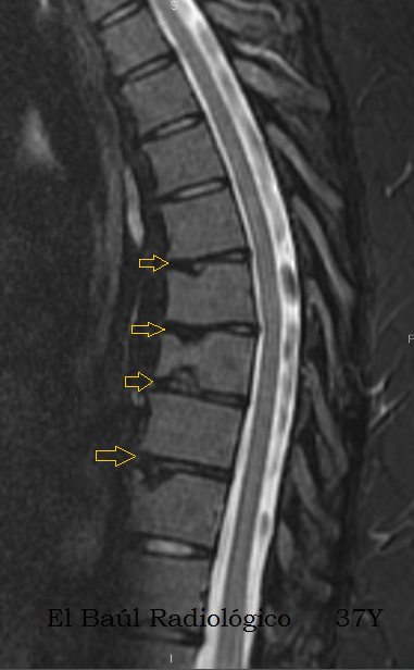 El Baúl Radiológico: ENFERMEDAD DE SCHEUERMANN (DORSALGIA JUVENIL ...