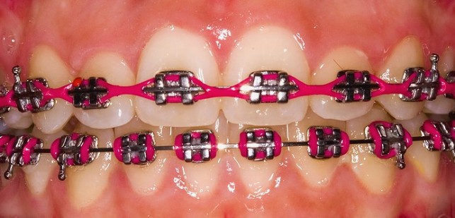 Brace yourself, because its Braces time.