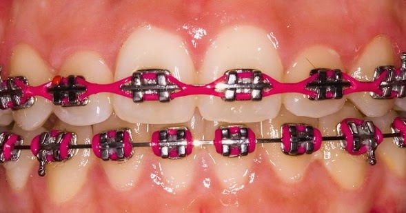 Brace yourself, because its Braces time.