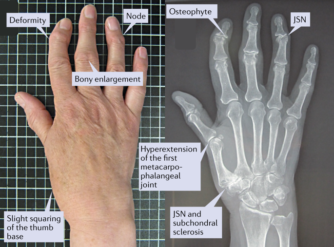 ER goldbook: Hand osteoarthritis