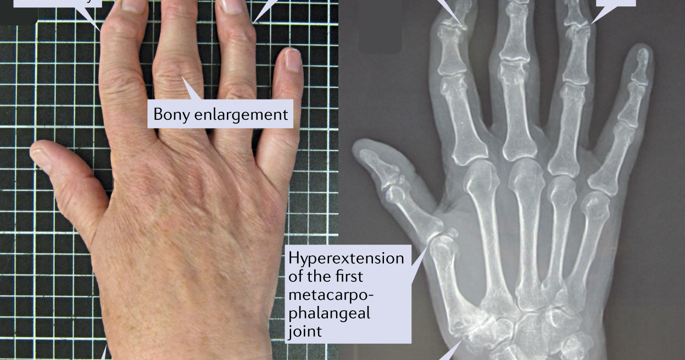 ER goldbook: Hand osteoarthritis