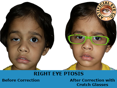 PTOSIS CRUTCH GLASSESS