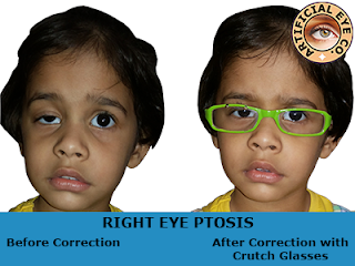 PTOSIS CRUTCH GLASSESS