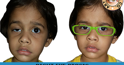 PTOSIS CRUTCH GLASSESS