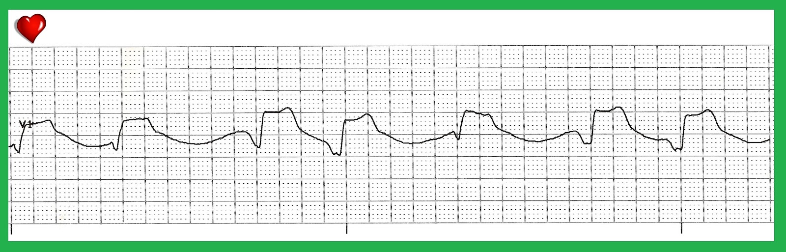 Practice EKG Strips