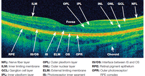 Esclerosis-Multiple-MSblog: OCT as biomarker in Multiple Sclerosis ...
