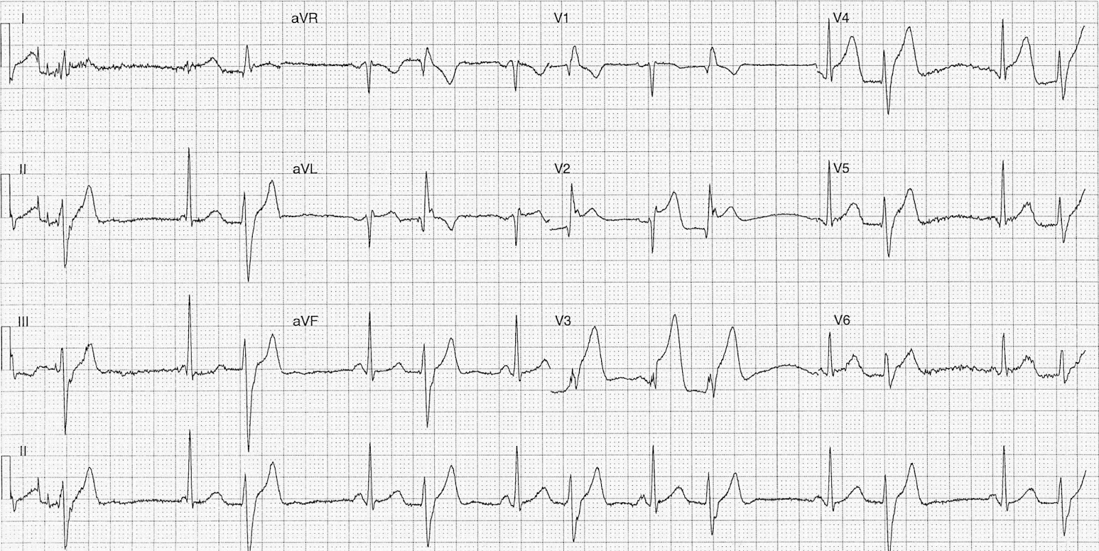 ECG of the Week: ECG of the Week - 2nd September 2013 - Interpretation