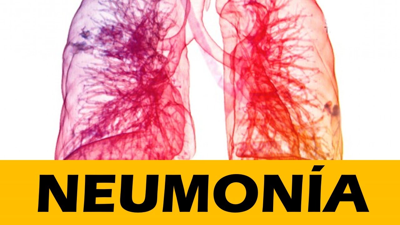 Neumonía