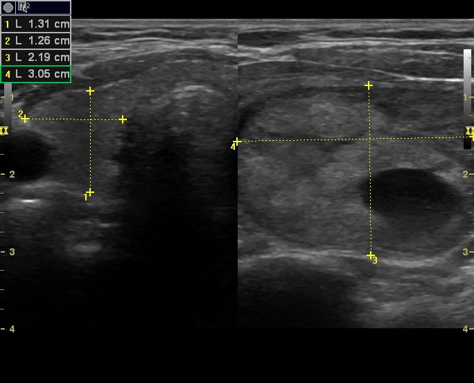 cochinblogs: Colloid nodule of the thyroid- 3D and elastography study: