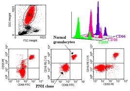 Cancer, A Lab Tech 's Perspective: Blood Disorder: Paroxysmal Nocturnal ...