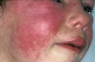 Scarlatina Rash Pictures | Medical Pictures