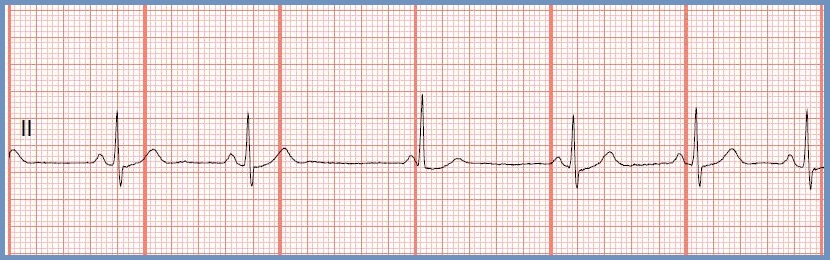 Practice EKG Rhythm Strips 144: Various Escape Beats